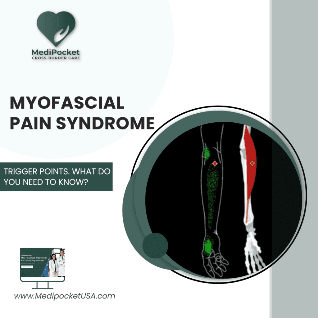 Myofascial Pain Syndrome: Understanding Trigger Points