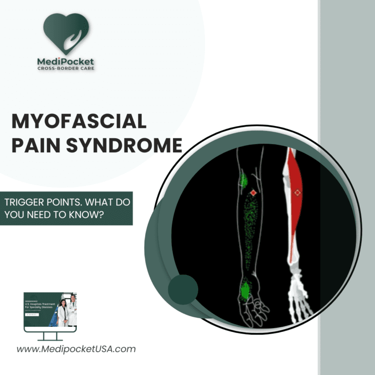 Myofascial Pain Syndrome: Understanding Trigger Points