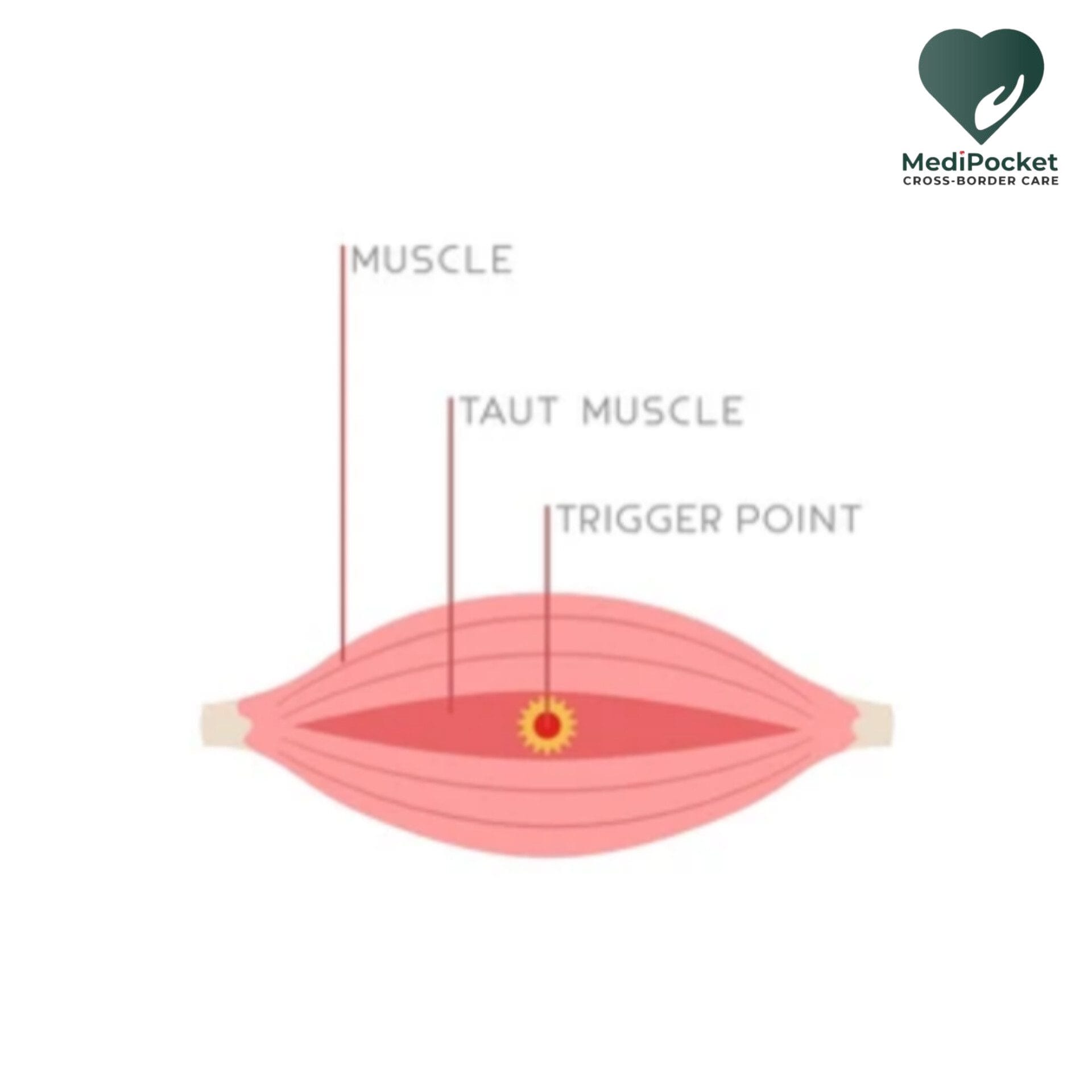 Myofascial Pain Syndrome: Understanding Trigger Points