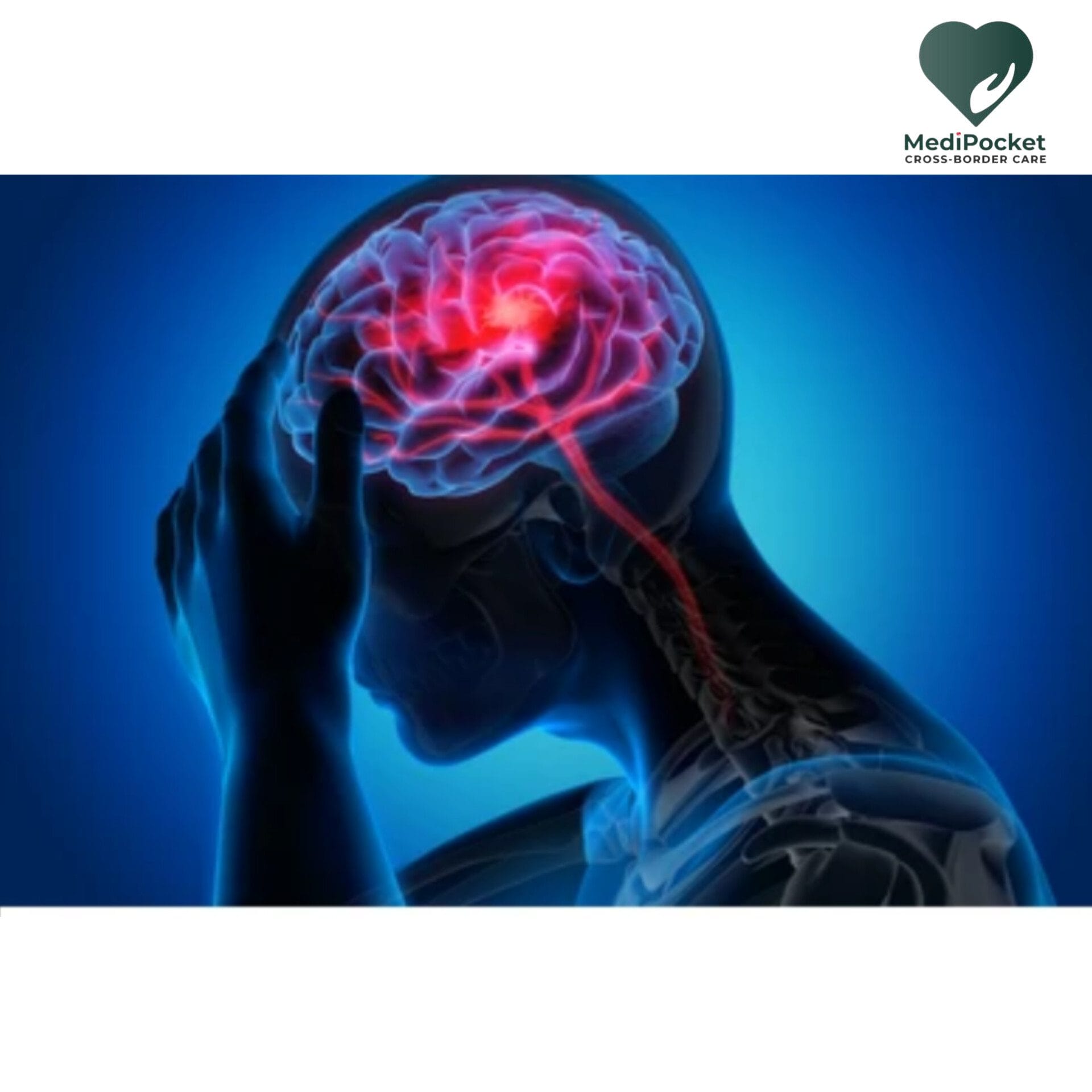 Difference between Stroke and seizure | Medipocket USA